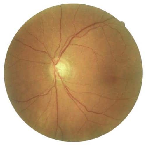 Glaucome symptômes et traitements | Ophtalmo Paris - Dr Gavrilov