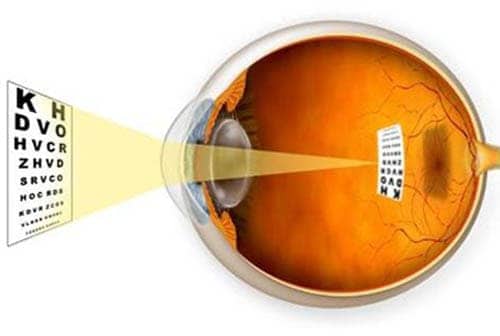 Myope définition & opération myopie | Ophtalmo Paris - Dr Gavrilov